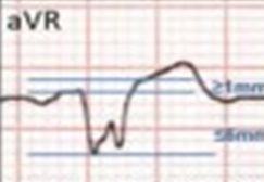 Electrocardiographic Criteria for Diagnosis of Acute Myocardial ...