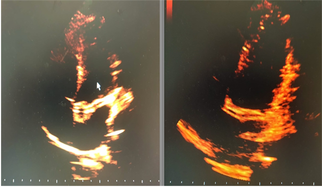 Incidental diagnosis of Coronary Anomaly of the Circumflex Artery with ...