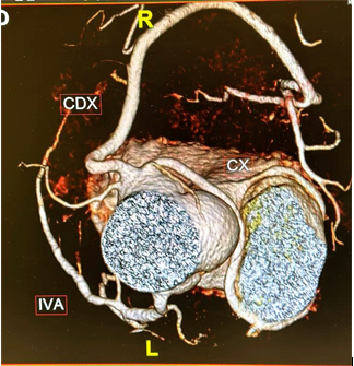 Incidental diagnosis of Coronary Anomaly of the Circumflex Artery with ...