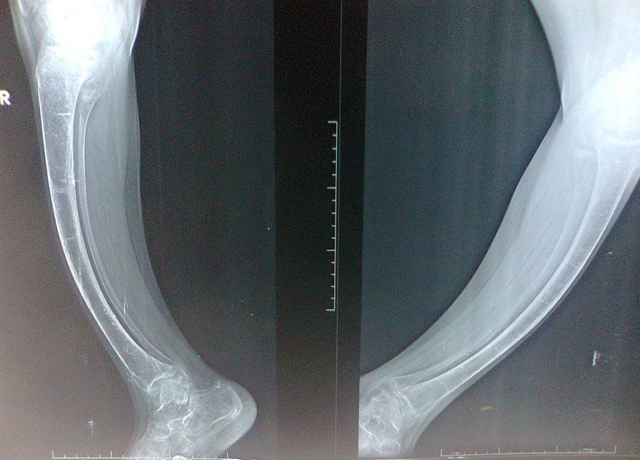 Ekman-Lonstein syndrome in Iraq: An educational article and expert ...