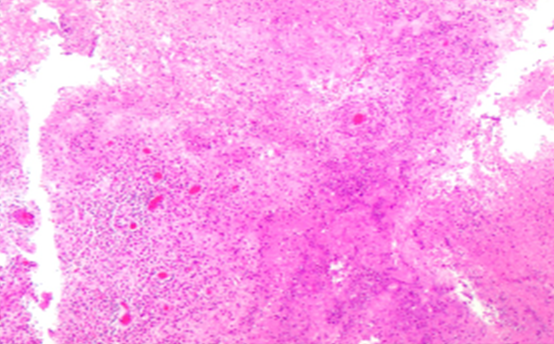 Ileocecal Tuberculosis Mimicking Malignant Tumors | ClinicSearch